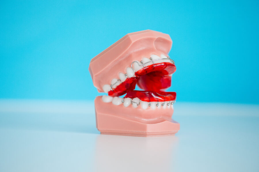 Informatie over de Twin Block - Ortho Leidschendam-Voorburg